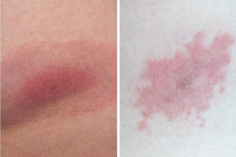 Keep Ticks Away When Hiking: Tips and Tricks - The Hiking Adventure