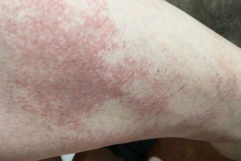 Avoid Hiker Rash: 7 Tips for Comfortable Hiking Adventures